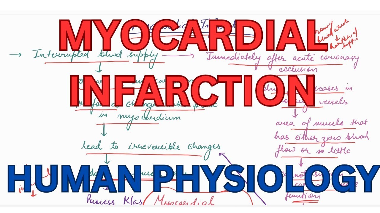 Myocardial Infarction, Subendomyocardial Infarction, CVS Human ...