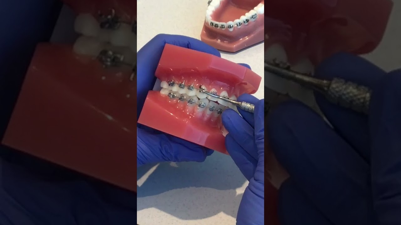 Class III Vertical Elastic - YouTube