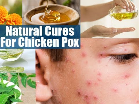 Chicken Pox | How to Cure Chicken Pox - YouTube