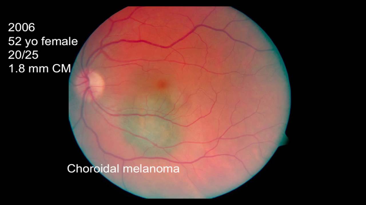 Tara McCannel, MD, PhD - Ocular Oncology at UCLA: Evolving a Modern ...