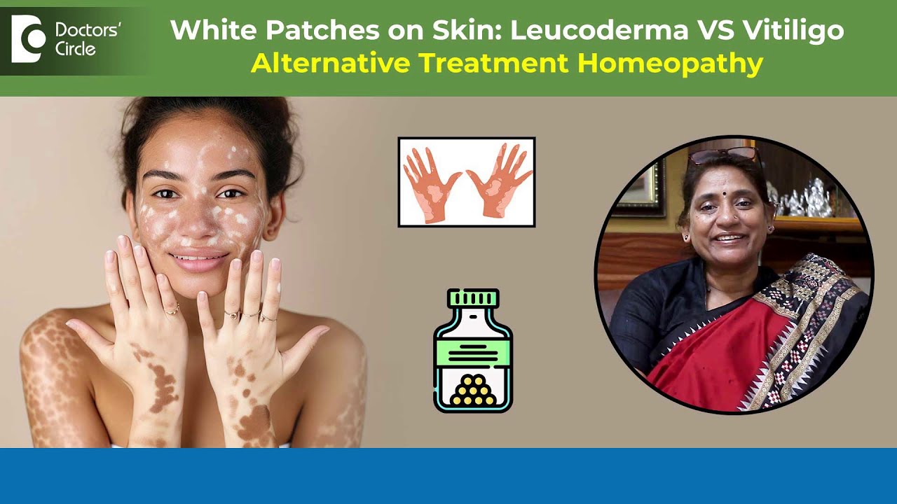 WHITE PATCHES on Skin: Leucoderma VS Vitiligo Homeopathy Treatment-Dr.Surekha Tiwari|Doctors ...