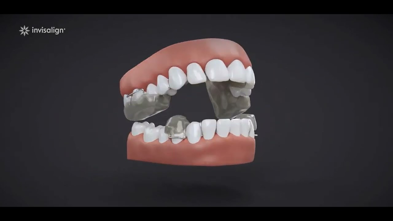 Invisalign Treatment With Mandibular Advancement - YouTube