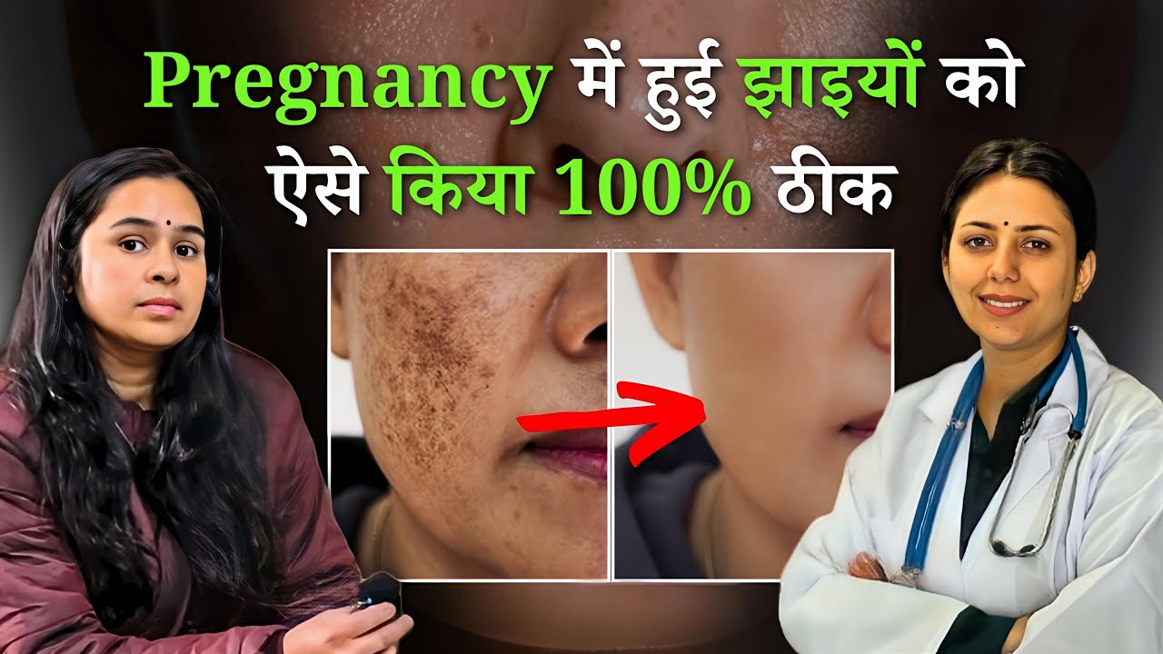 Pregnancy में हुई झाइयों को किया 100% ठीक बिना Cream लगाये ...