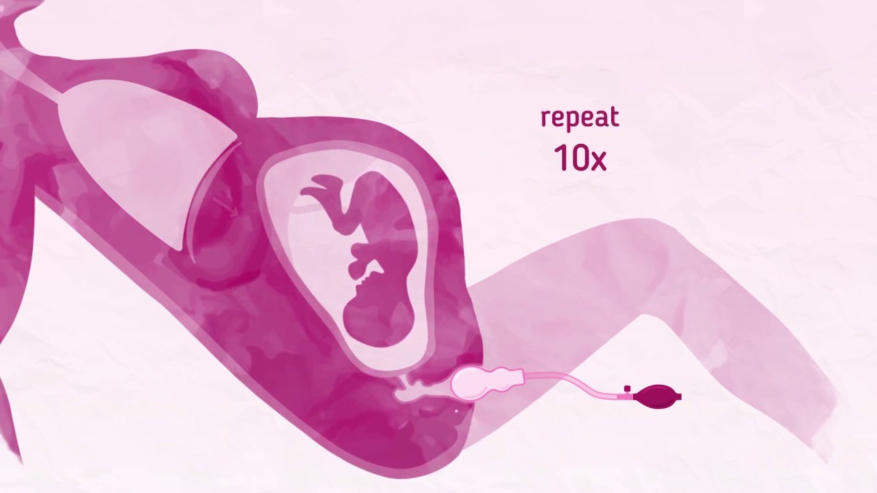 Instructievideo Aniball geboortetrainer - YouTube