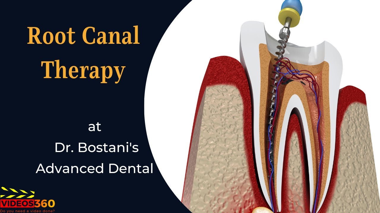 Root Canal Therapy at V360 Dr Bostani - YouTube