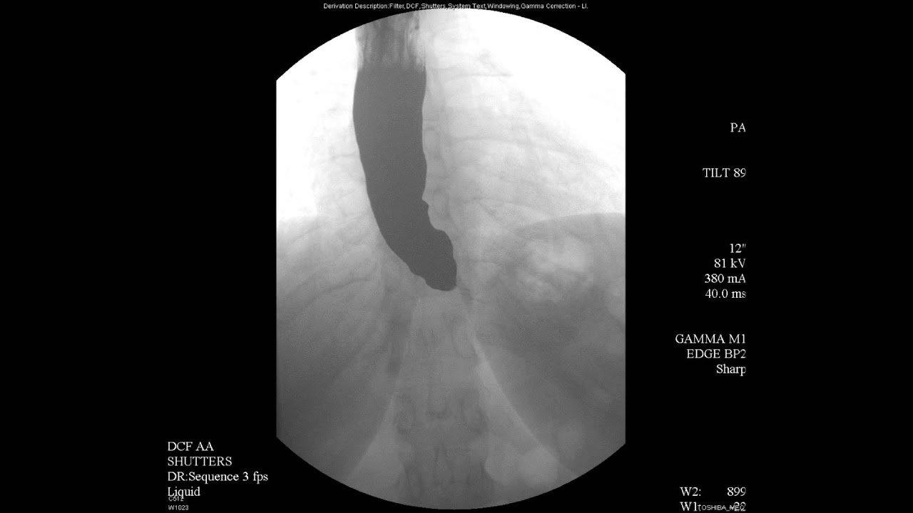A barium swallow showing a birds beak - Achalasia - YouTube