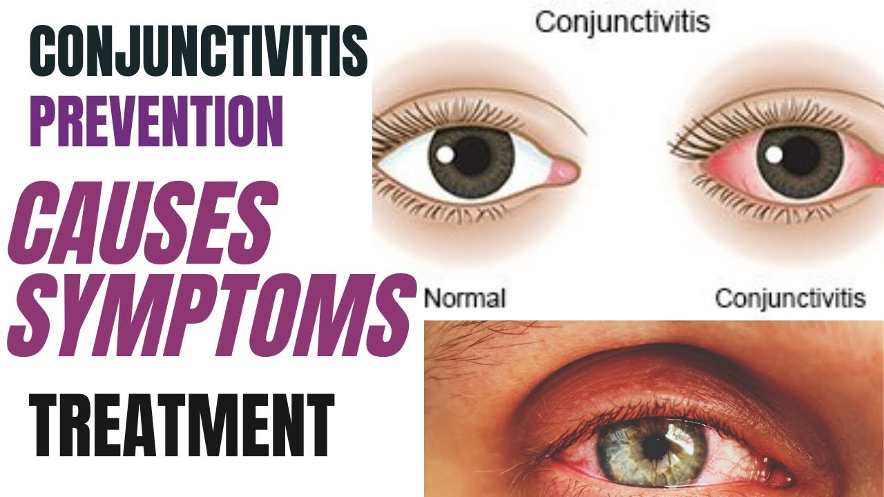 Conjunctivitis क्यों होता है | Kaise Thik करे with in a week. - YouTube