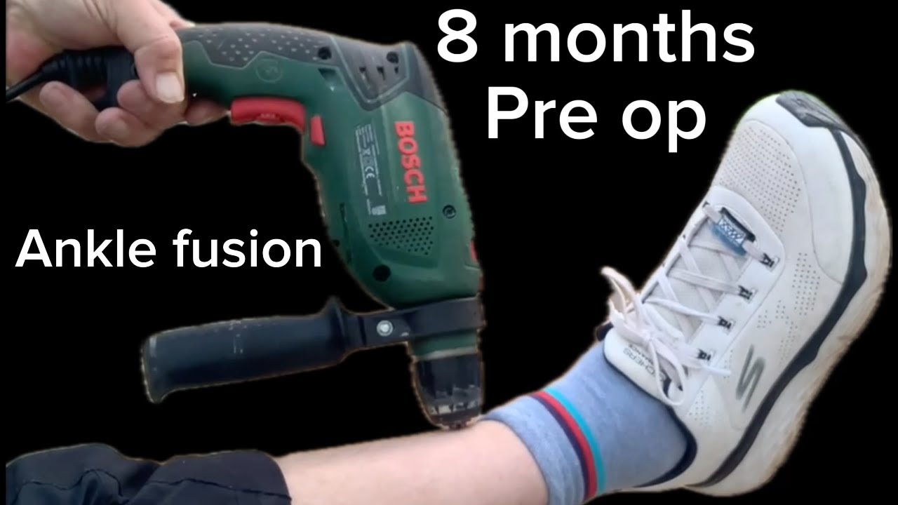 the-truth-about-ankle-fusion-recovery-youtube