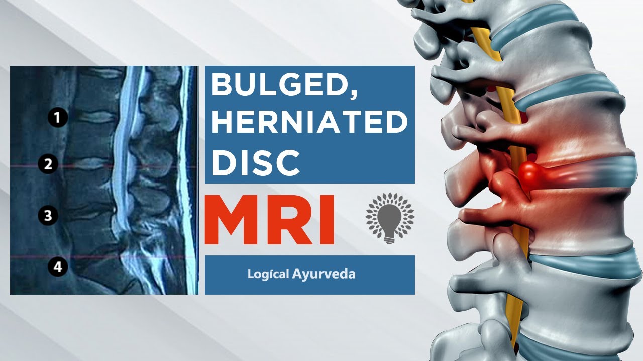 How to Read a MRI of a Lumbar Herniated Disc| Bulged Disc| - YouTube