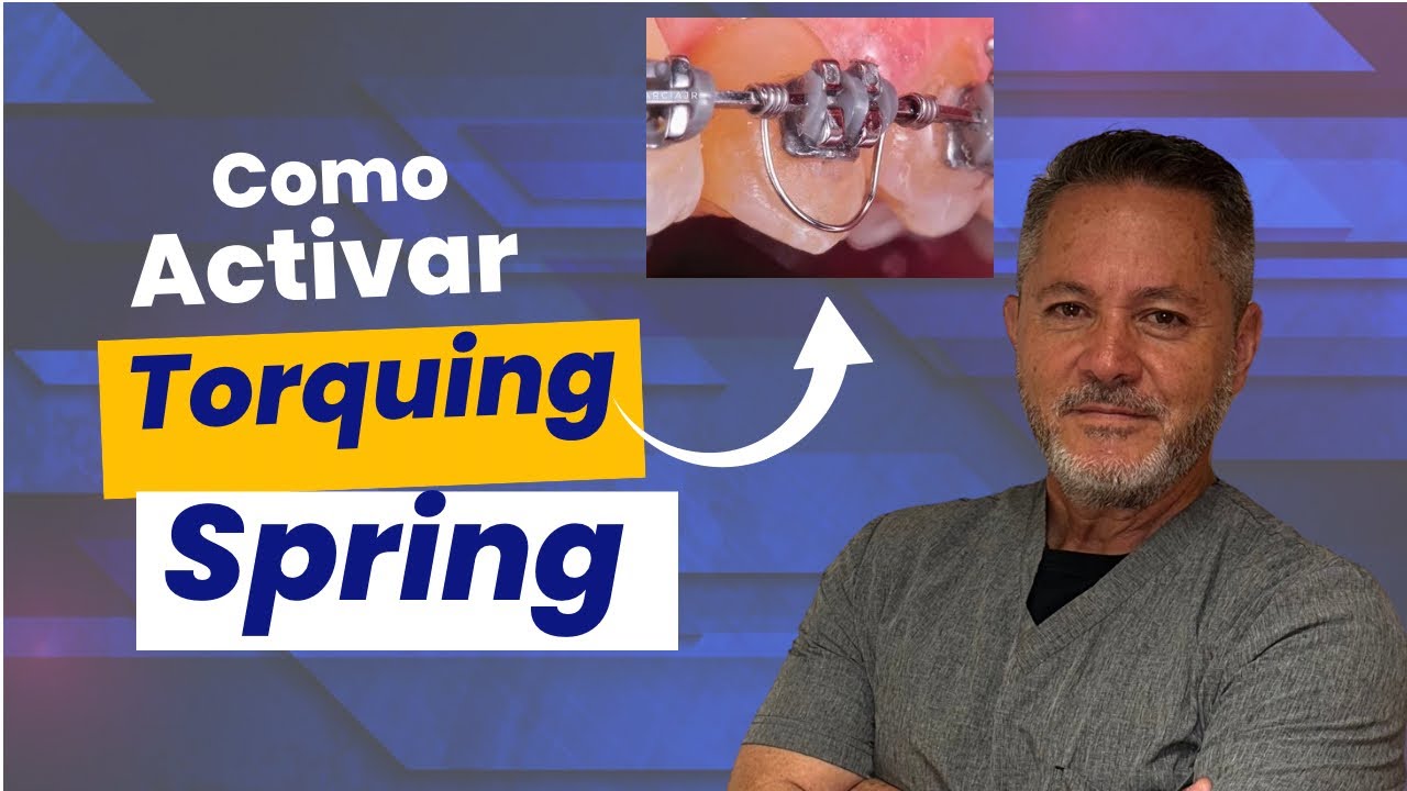 Como activar un torquing spring en la consulta - YouTube