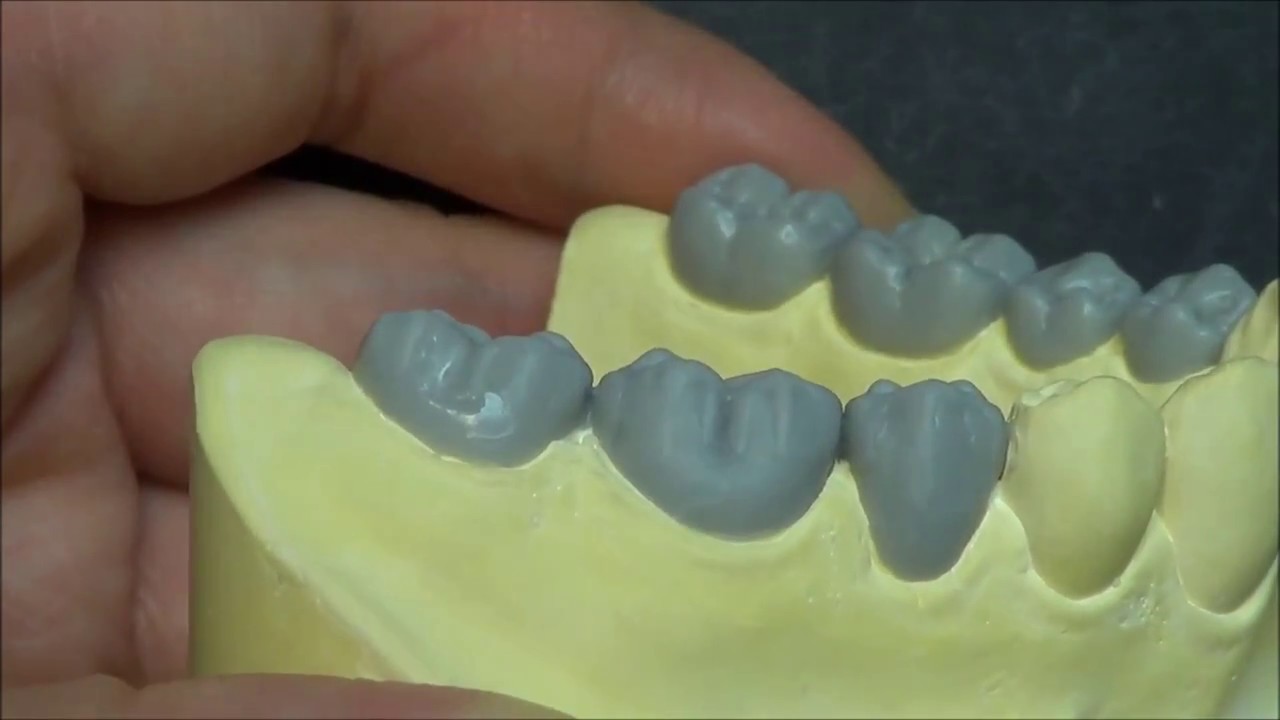 Live wax up - Lower Posterior bridge (occlusion1) - YouTube