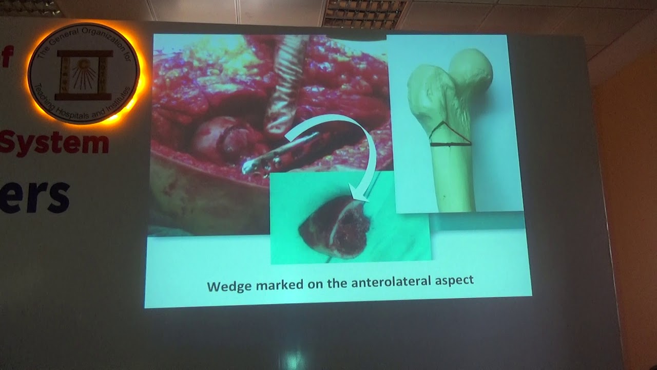 Imhauser osteotomy and osteochondroplasty part 1 Dr Mostafa Baraka ...