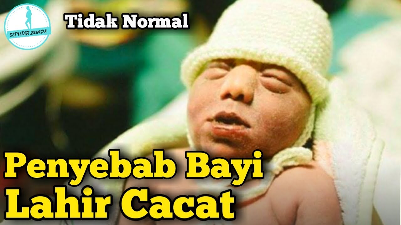 Penyebab Bayi lahir Cacat Atau Tidak Normal, Berikut Penjelasannya ...