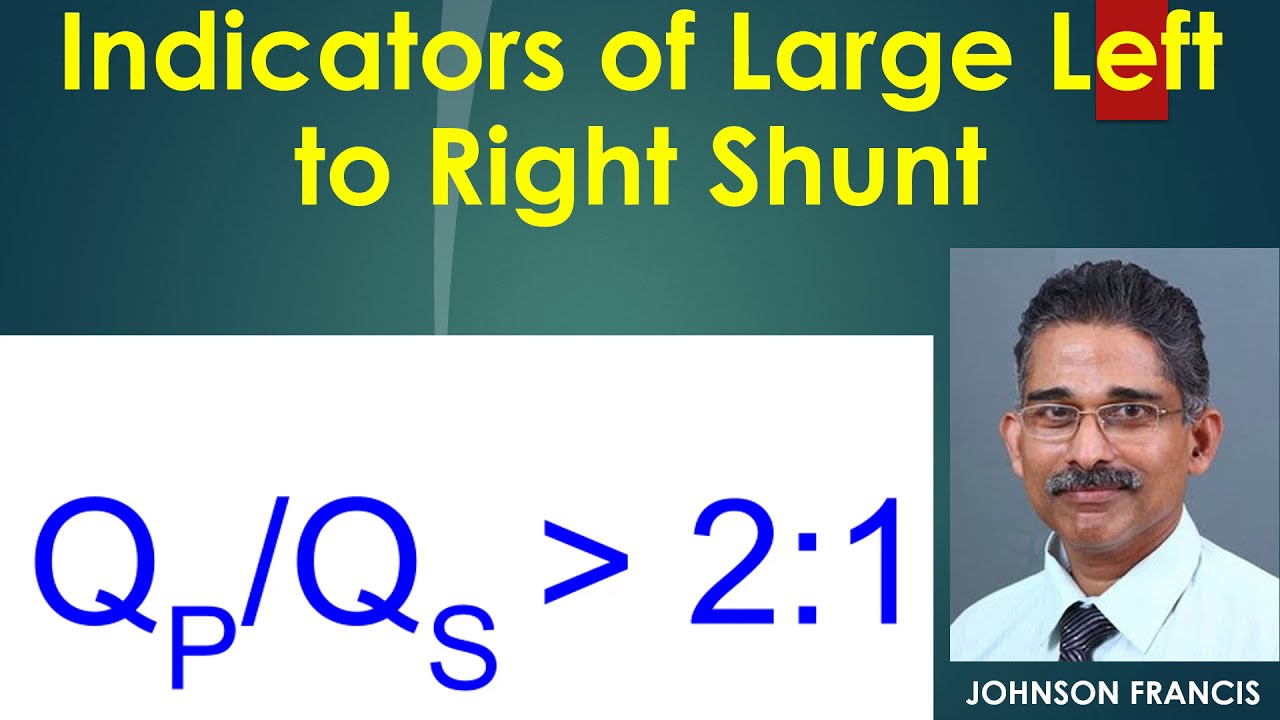 Indicators of Large Left to Right Shunt - YouTube