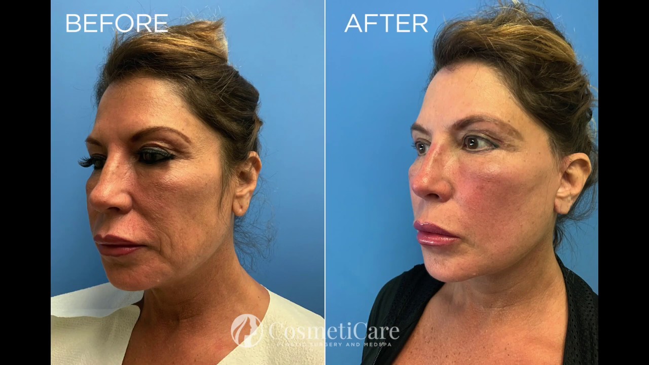 Watch Facelift Surgery in Operating Room - YouTube