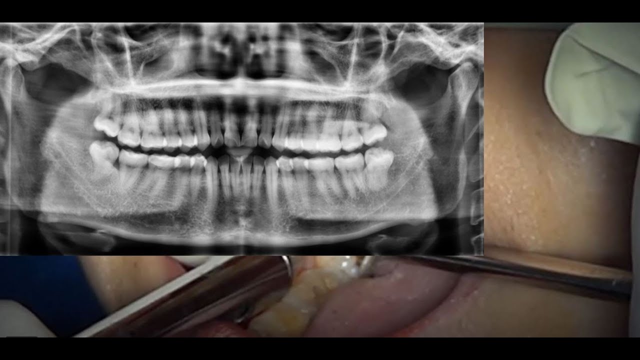 Nhổ răng khôn cả 4 răng BN 1987 - Wisdom Tooth Extraction - Step By ...