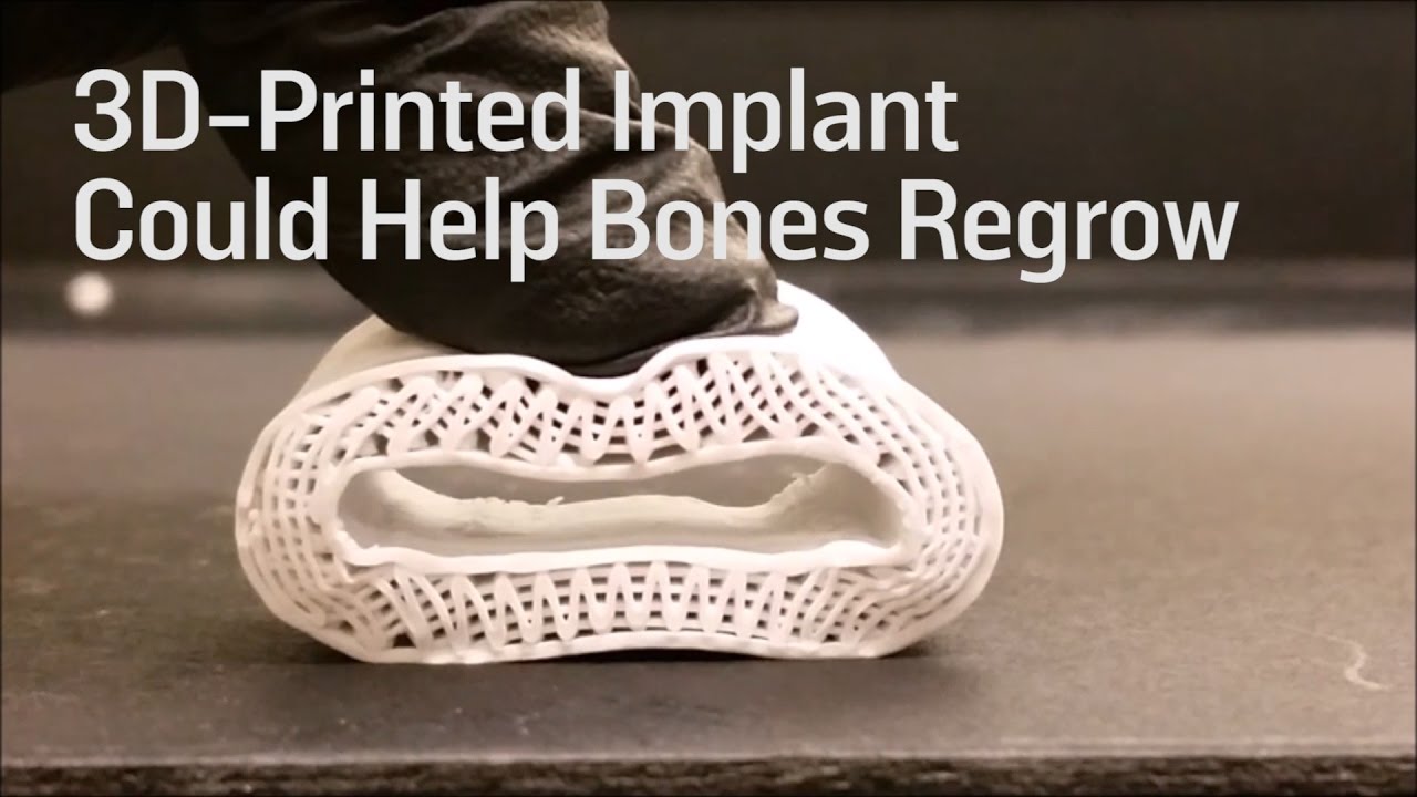 3D-Printed Implant Could Help Bones Regrow - YouTube