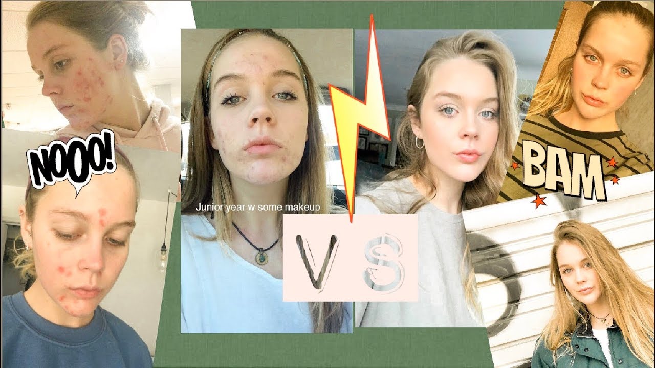 THE *ONLY* THING THAT CLEARED MY ACNE | Accutane Journey Log w ...