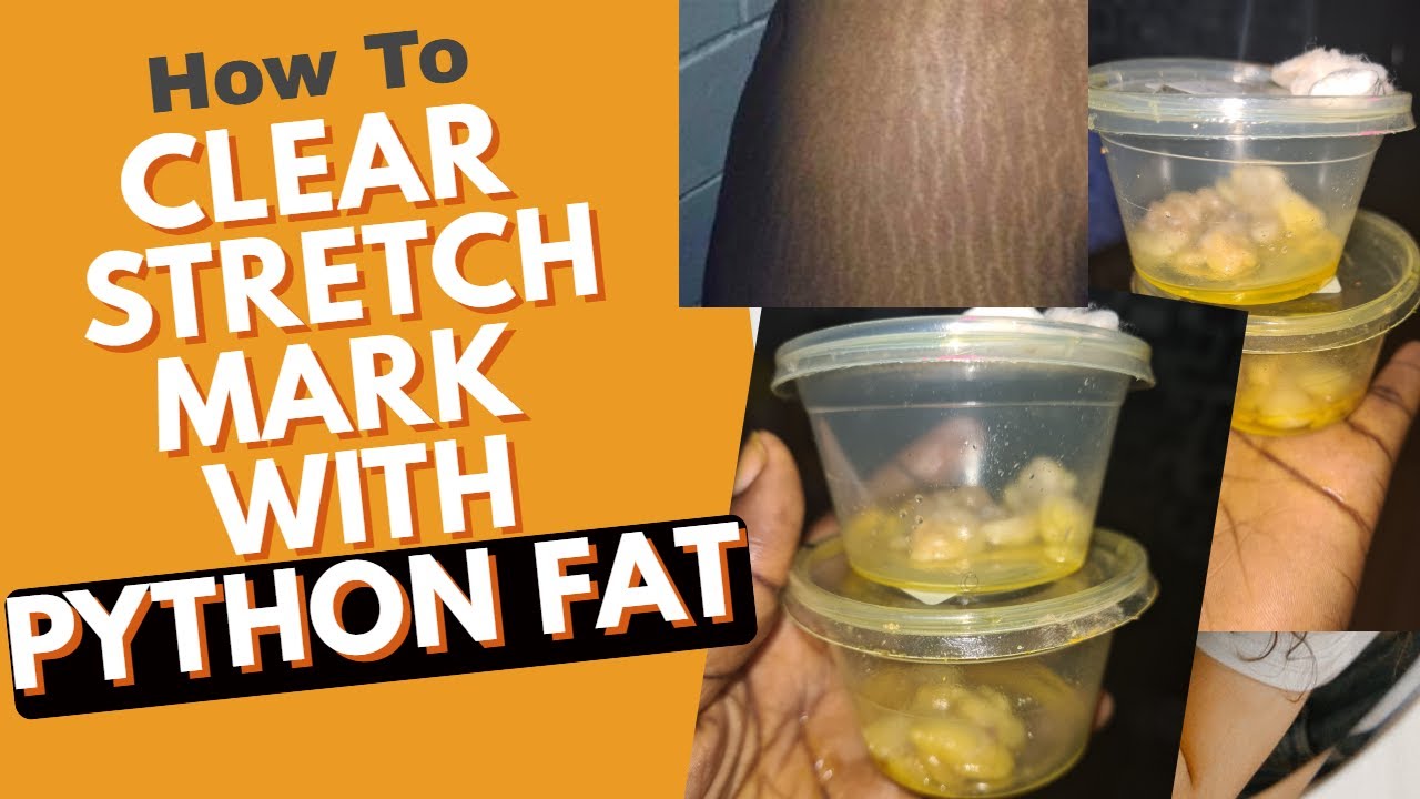 HOW TO TREAT KELOID & GET RID OF STURBORN STRETCH MARKS FAST WITH ...