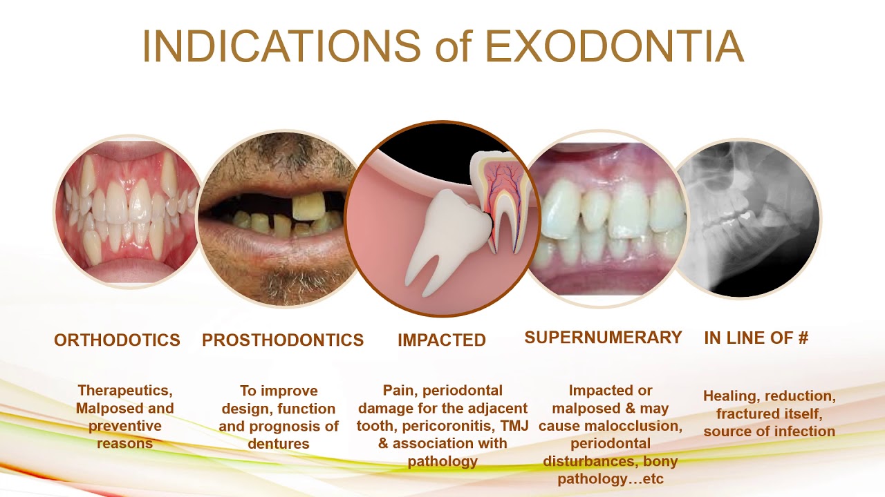 indication and contraindication of exodontia - YouTube