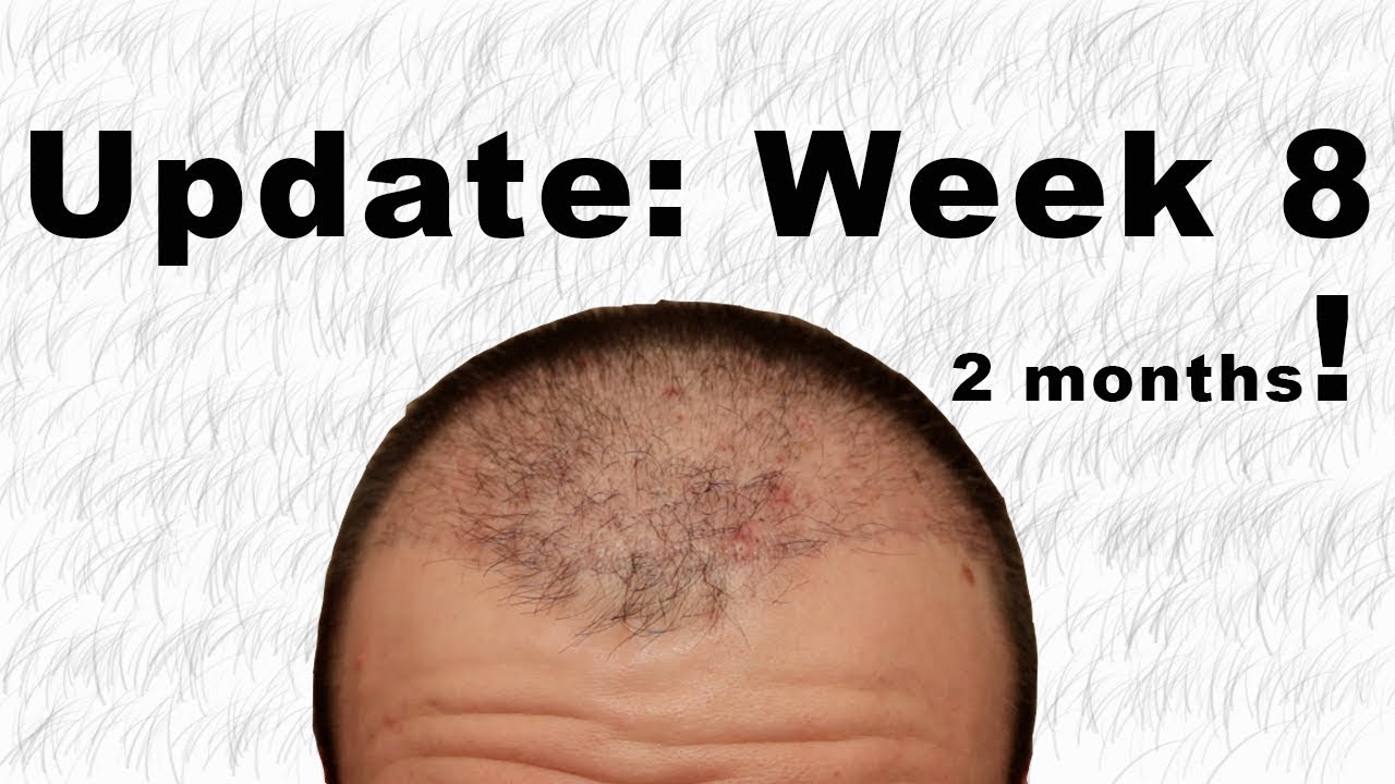 8 Weeks Post Operation - YouTube