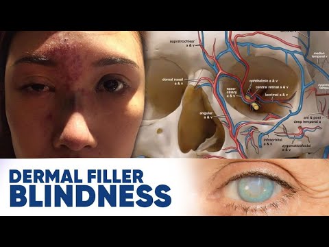 Understanding Dermal Filler Blindness: Causes, Risks & Prevention - YouTube