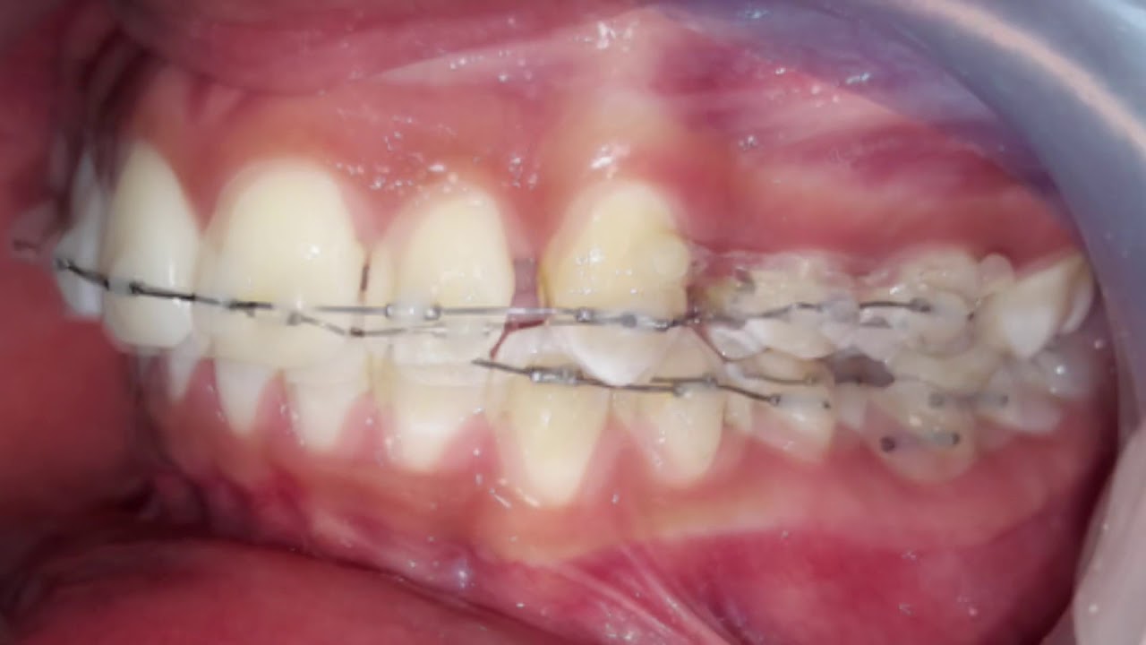 FLOW JAC SYSTEM.Sistema ortodóncico de Minitubos Ortodoncia sin ...