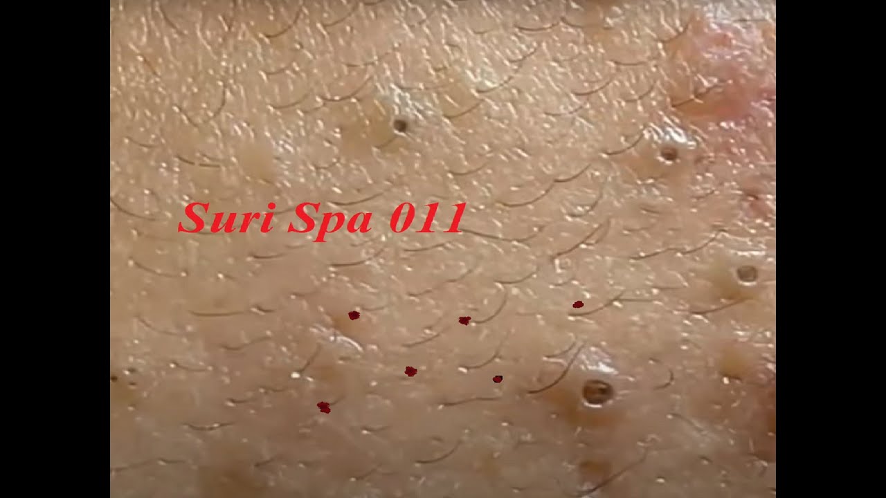 Make Your Acne Treatment with Suri Spa #011 | Suri Spa 2022 - YouTube