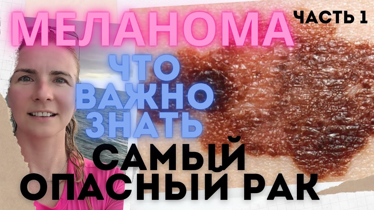 Меланома Рак кожи Стадии рака Классификация Признаки