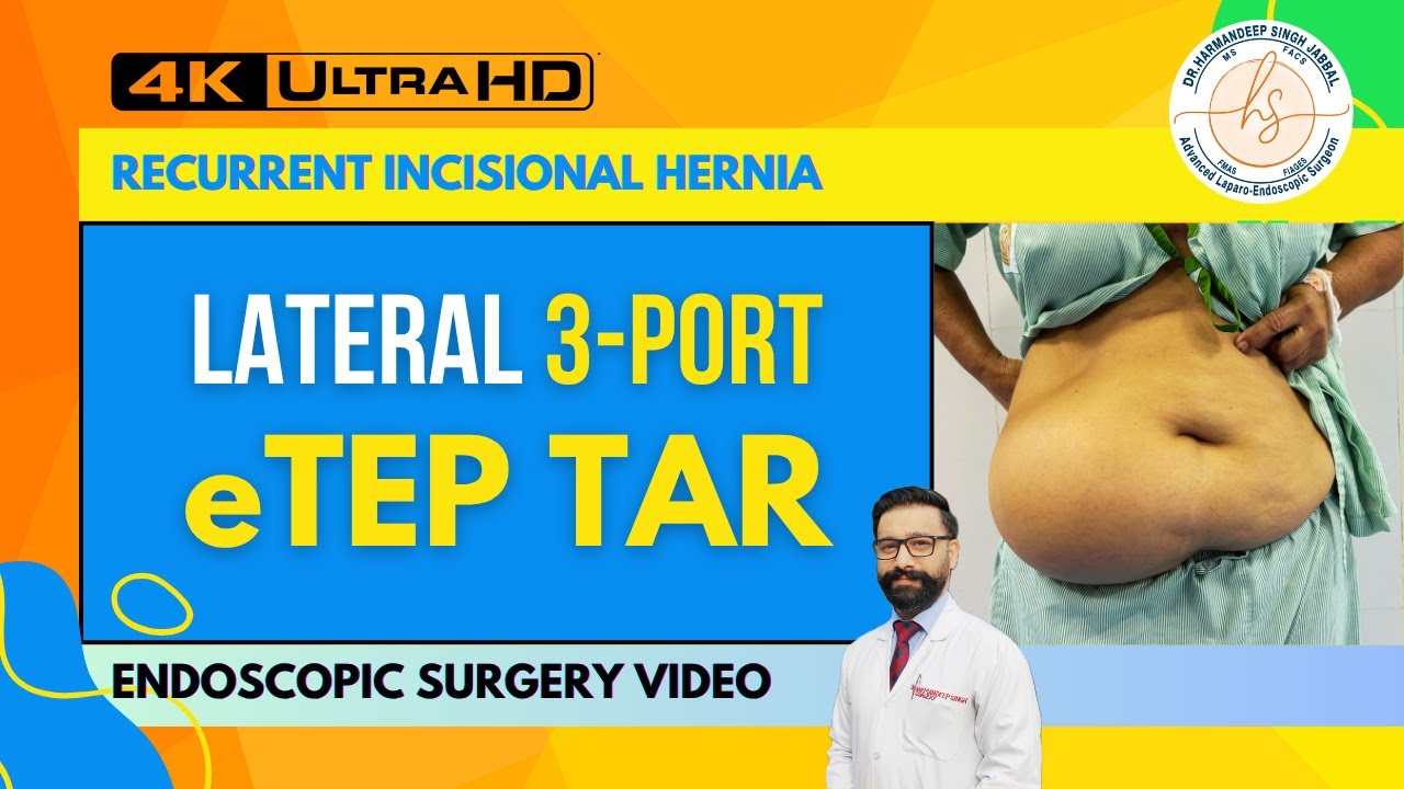 eTEP TAR - AWR - Recurrent Incisional Hernia - Lateral 3 Port - Limited ...