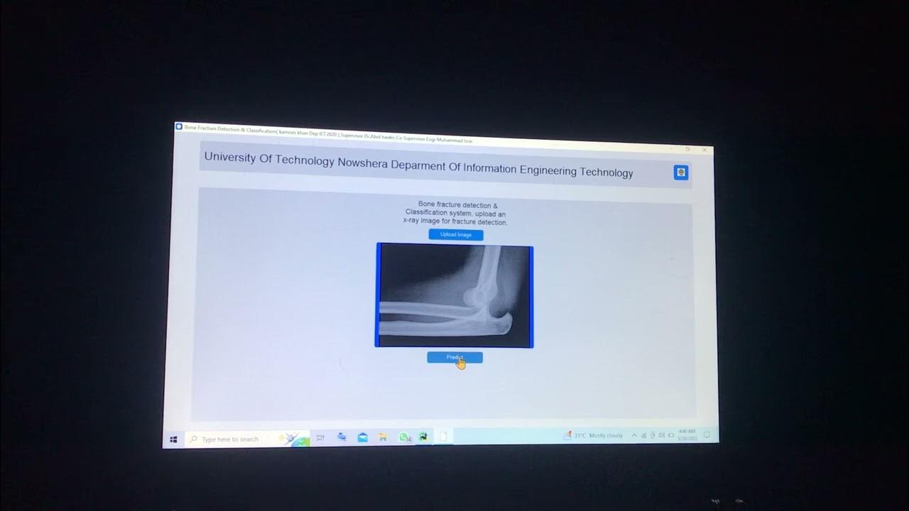 Bone fracture detection on CNN full project using python FYP #fyp#bone#fracture#Cnn - YouTube
