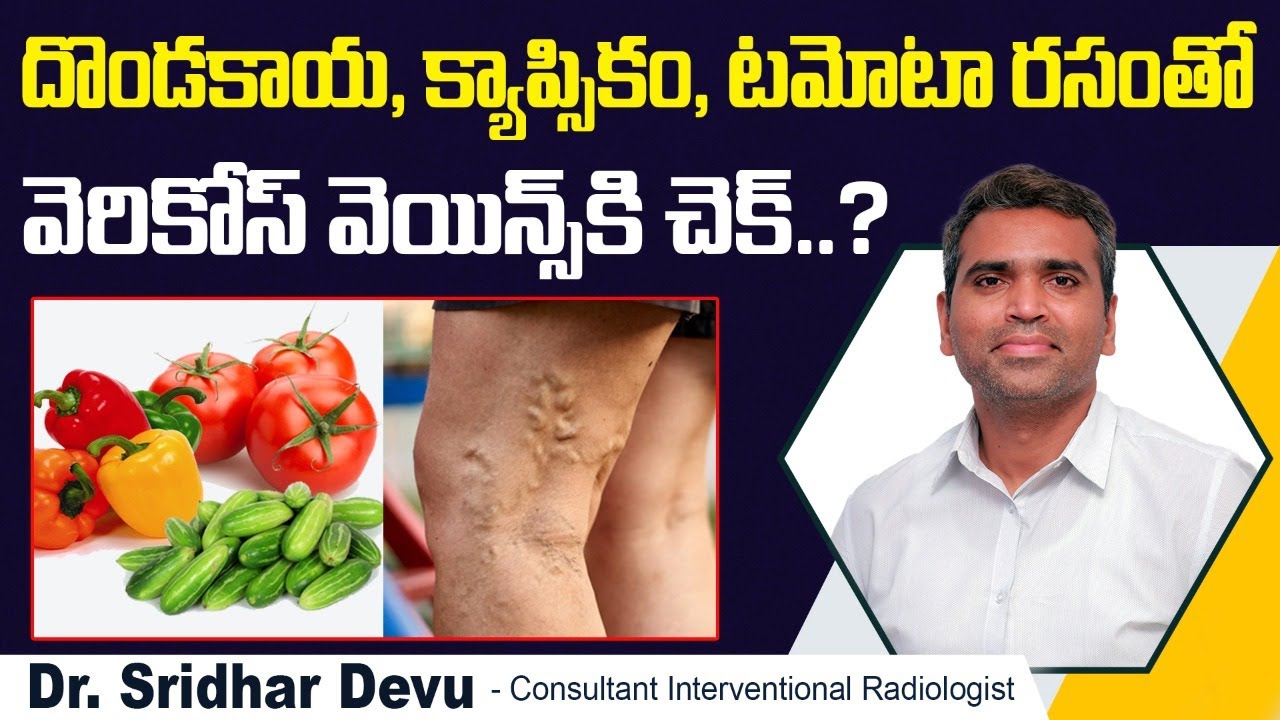 వెరికోస్ వెయిన్స్ తగ్గించే ఆహారాలు | Home Remedies to Treat Varicose ...