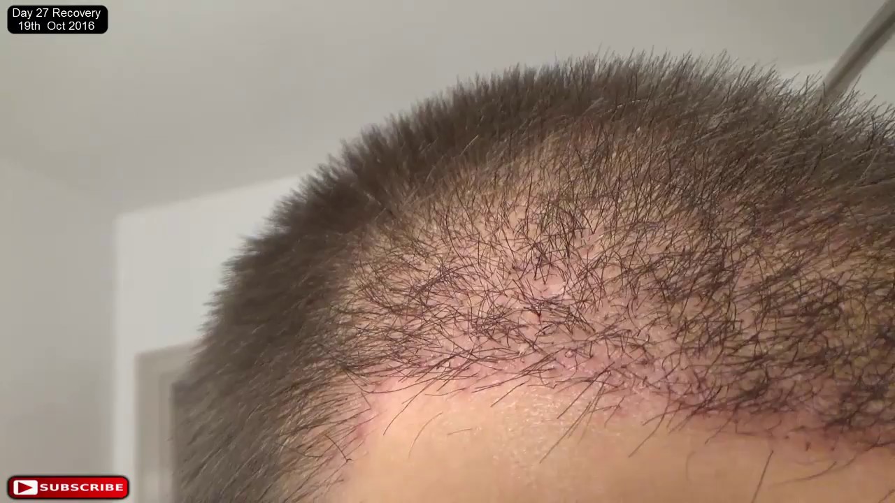 Fue Hair Transplant Day 27 Post Op Recovery Youtube