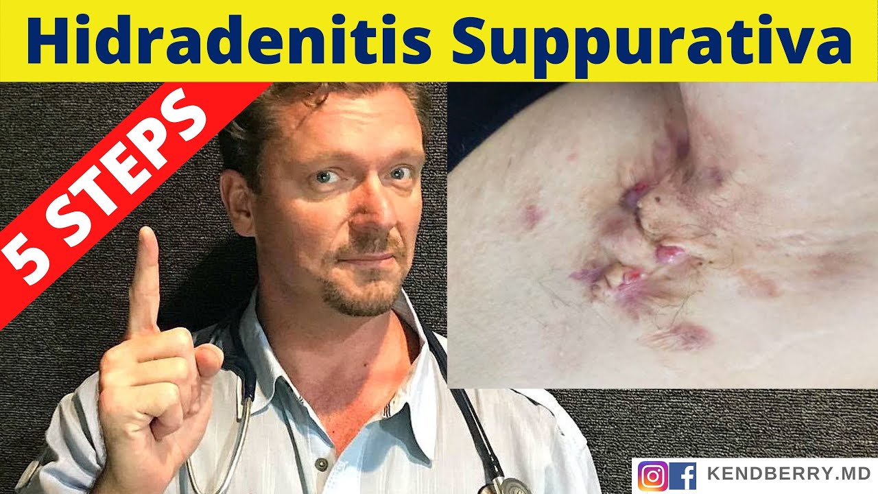 HYDRADENITIS SUPPURATIVA (5 Steps to Reverse HS) - YouTube