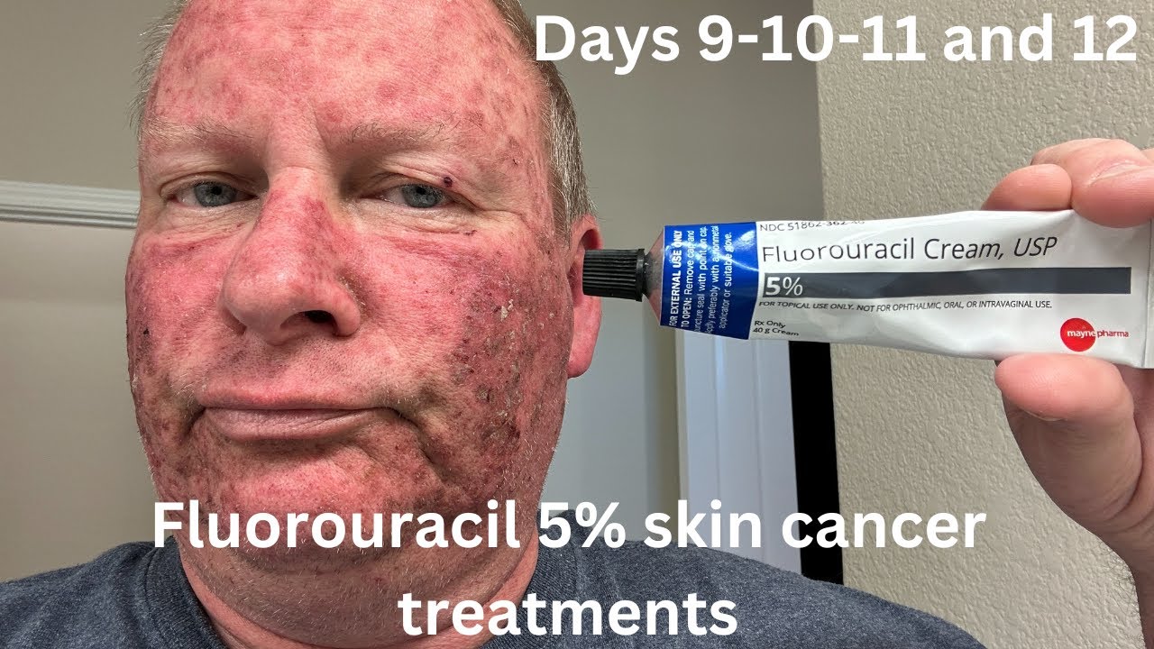 Fluorouracil skin cancer treatment days 9,10,11 and 12 - YouTube