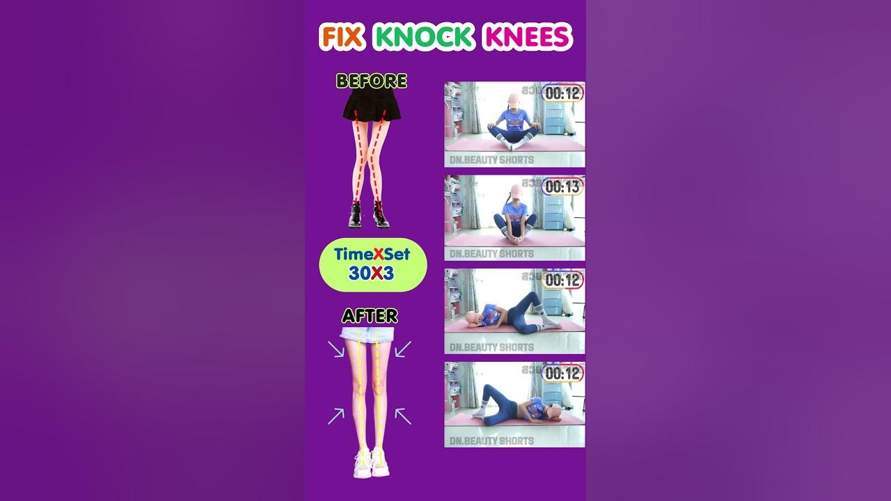 Knock Knees Correction Exercise Youtube