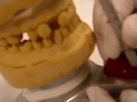 Custom Incisal Guide Table - Dr. Antonelli - YouTube