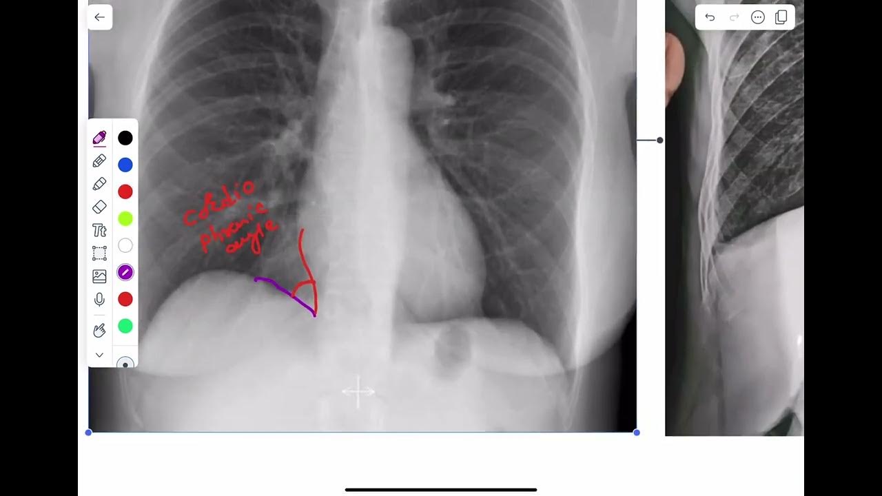 Chest Xray Normal Vs Copd Youtube