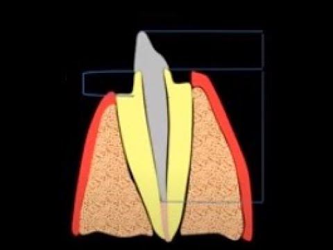 PREPARO DE DENTES EXTENSAMENTE DESTRUIDOS - RETENTOR INTRA RADICULAR ...