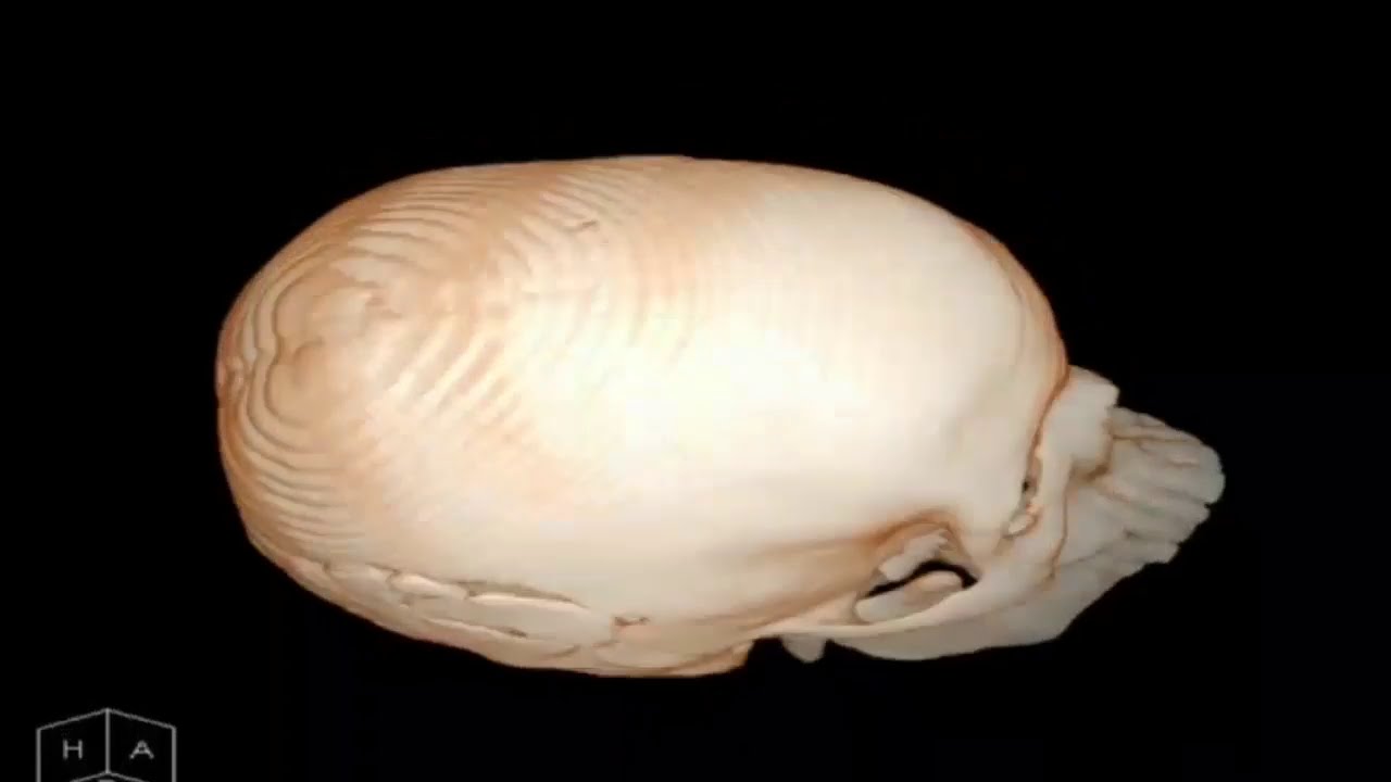 depressed skull fracture before and after surgery - YouTube