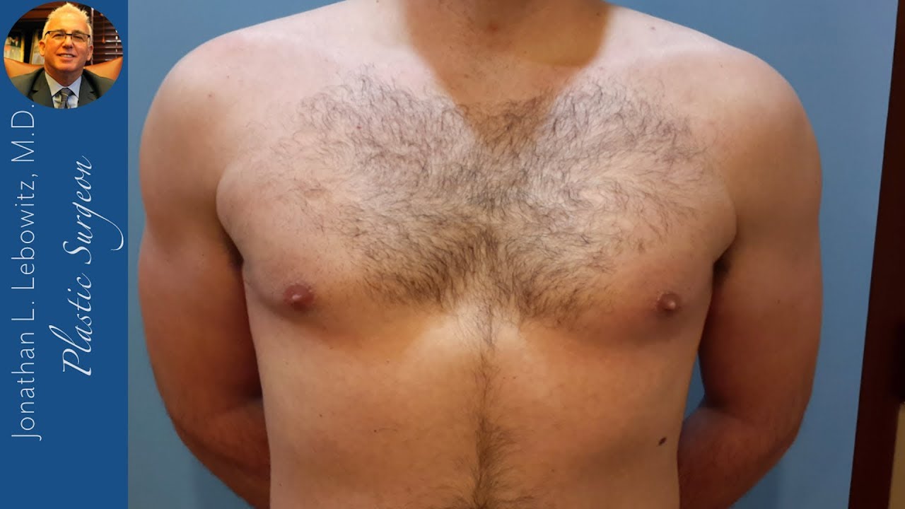 2 Weeks Post-Op! Gynecomastia Gland Removal At The Long Island ...