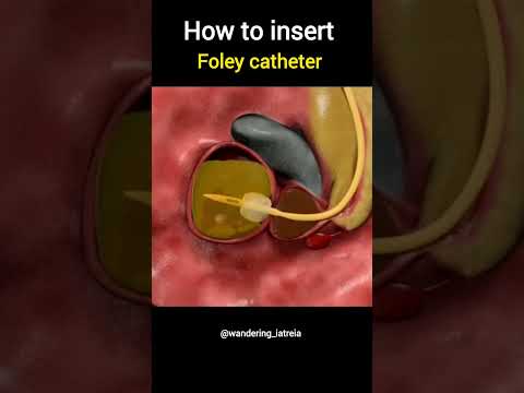 foley catheter insertion (3d animation) - explain in hindi - YouTube