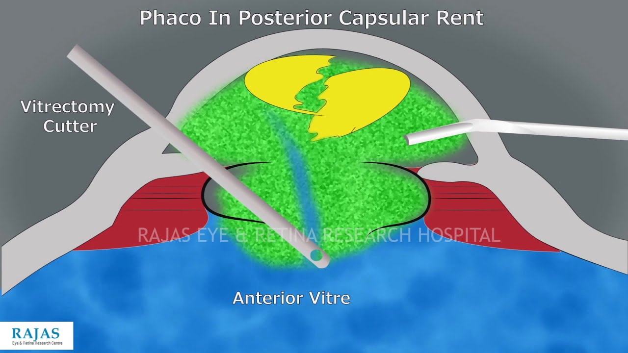 #2D Animation,PCR Management in Phaco Emulsification'' - YouTube