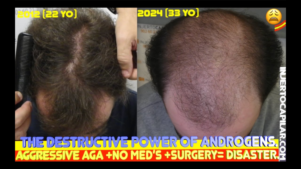 The destructive power of androgens. Aggressive AGA +no med’s +surgery ...