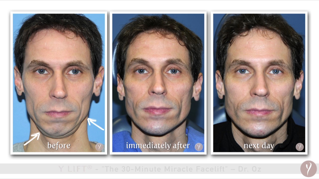 Be Your Most Handsome Self with the Y LIFT | Non-Surgical 30-Minute ...