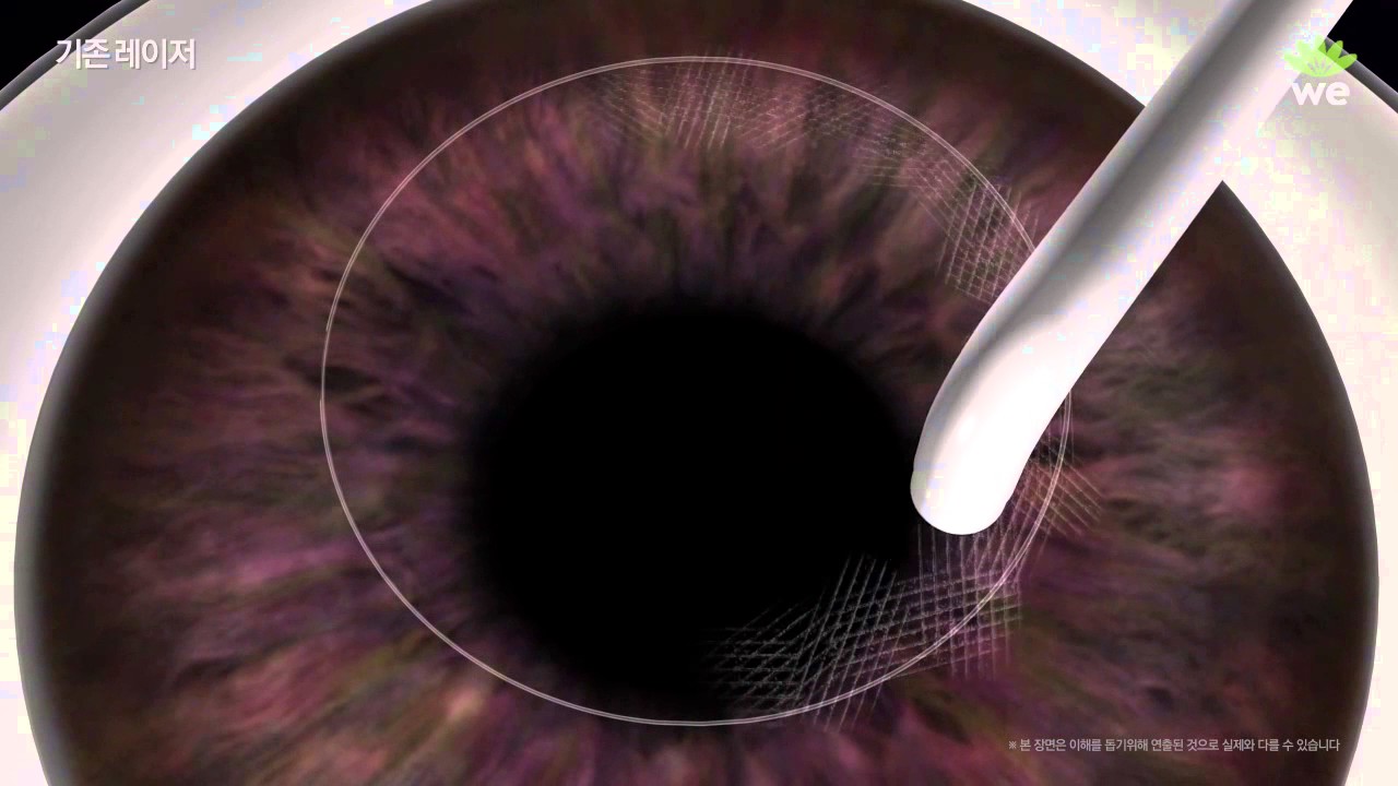 all laser lasek - YouTube