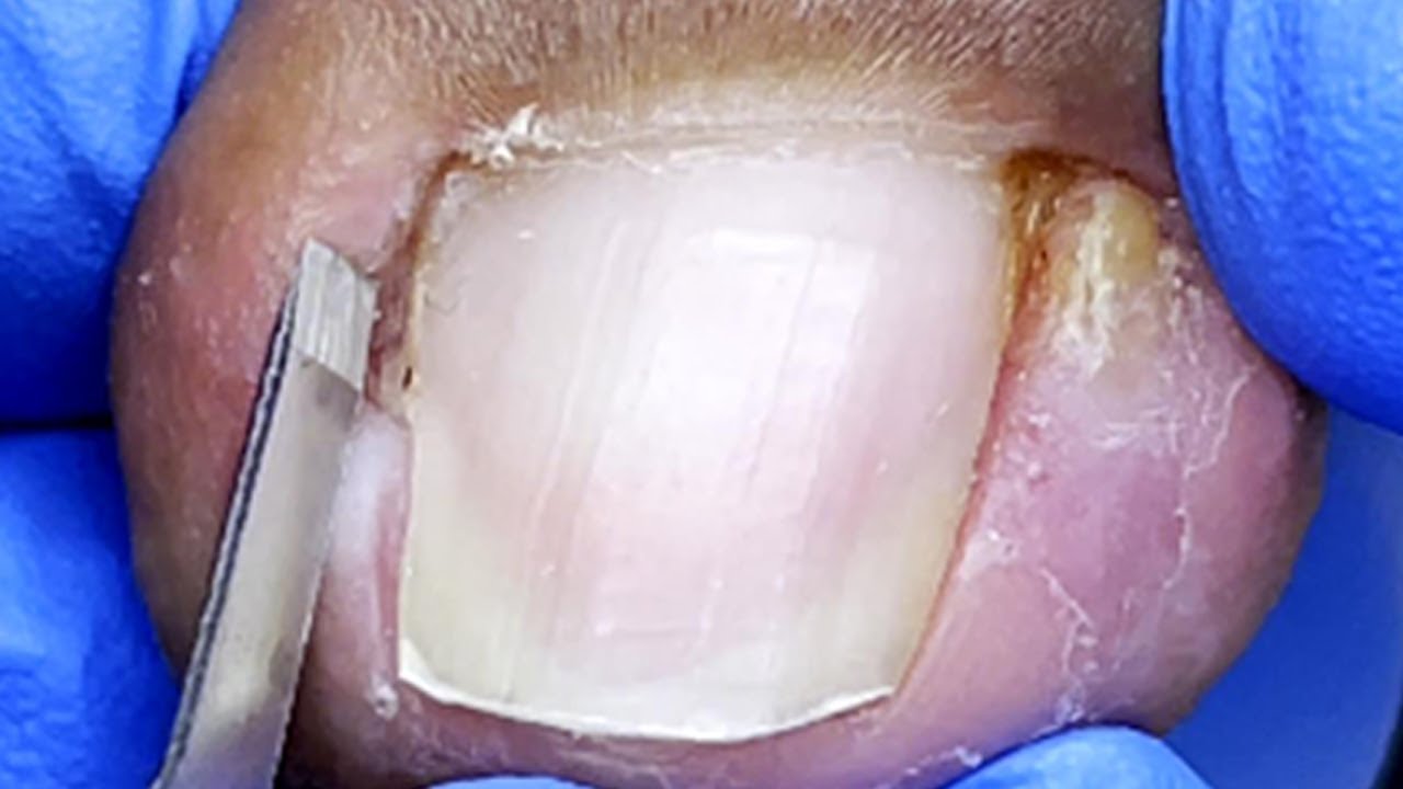 Pedicure Tutorial Sharp and Square Toenails 【Pedicure Master Lin Jun ...