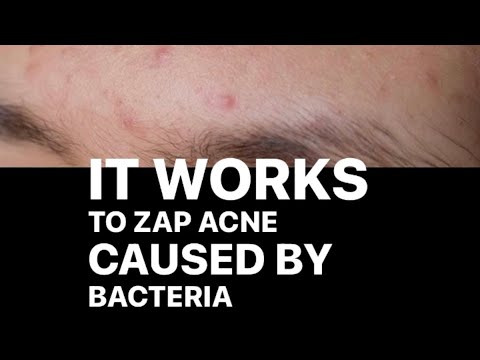 Acne between your eyebrows - YouTube