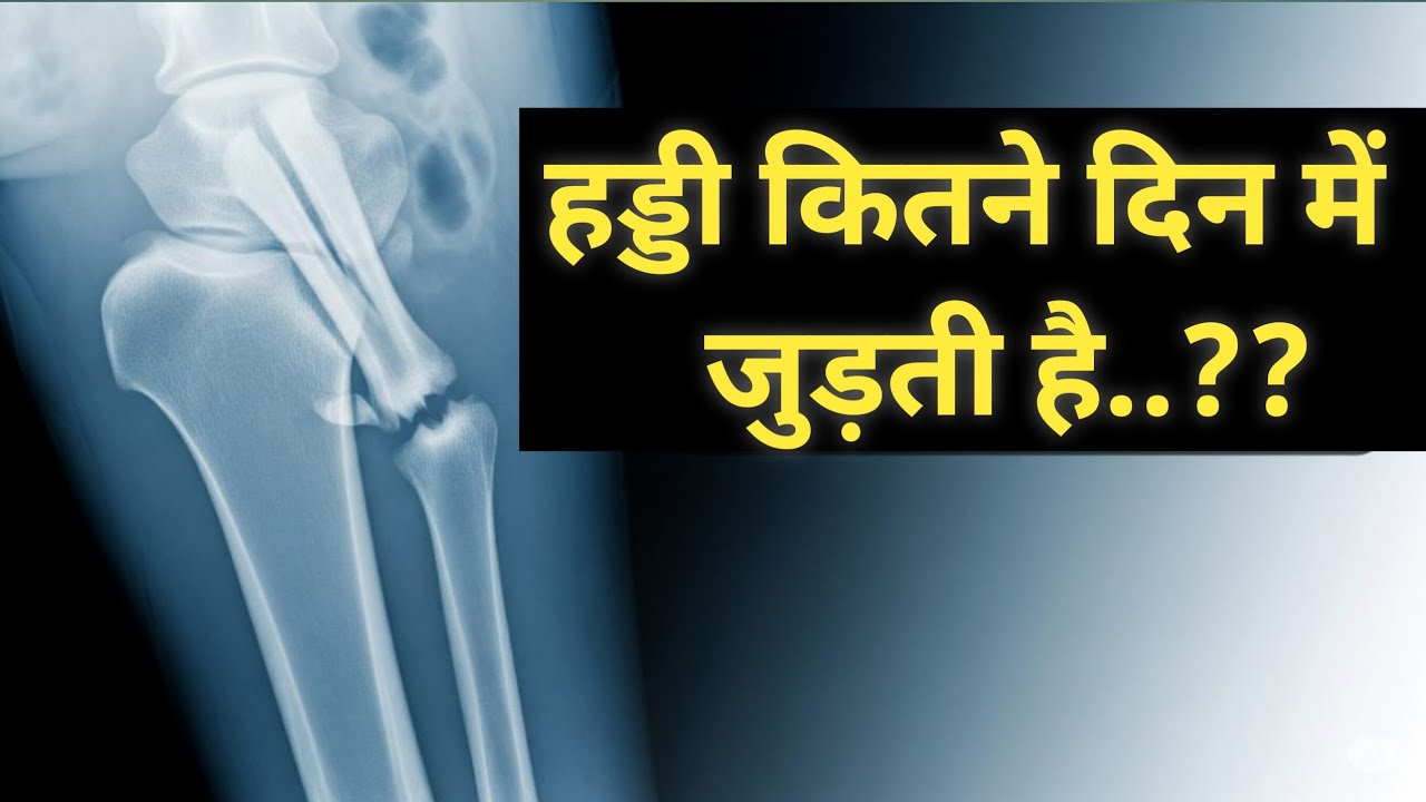 Haddi Kitne Din Mein judati Hai || Tibia fibula fracture recovery ...