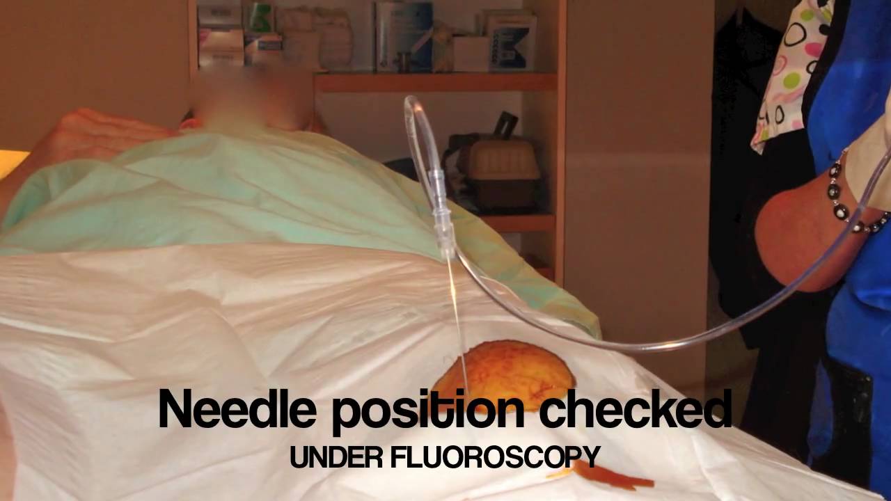 Knee Arthrogram - YouTube